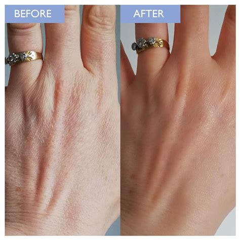 Glycerin For Skin Skinician
