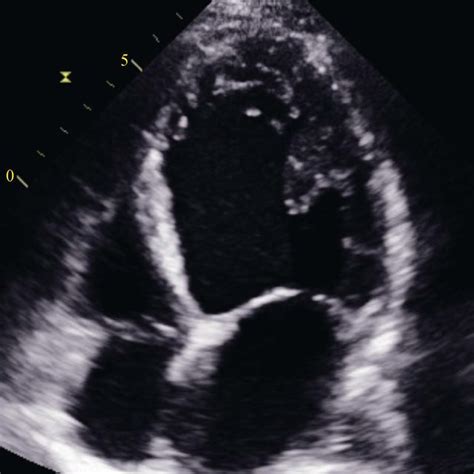 Two Dimensional Echocardiogram Showing Increased Apical Left