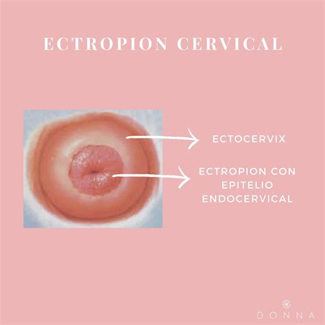 Donna Boutique El Ectropion O Ectopia Cervical Es La