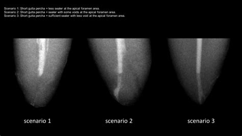 Can Calcium Silicate Based Sealer Cases Be Retreated American Association Of Endodontists