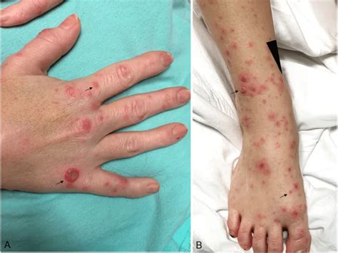 Rat Bite Fever Causes Symptoms And Prevention