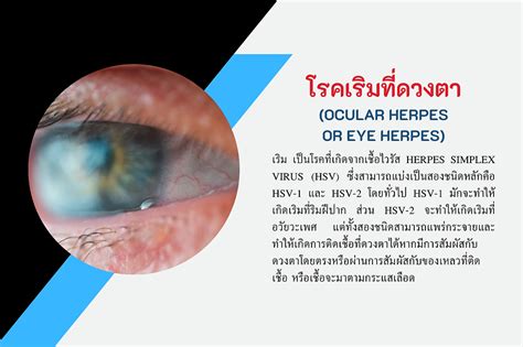 การมีเพศสัมพันธ์ที่ไม่ป้องกัน ความเสี่ยงเริม ซิฟิลิส และหนองในที่ดวงตา