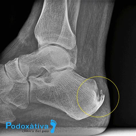 ¿qué Es La Bursitis Y Cómo Afecta A Tu Pisada Podoxátiva