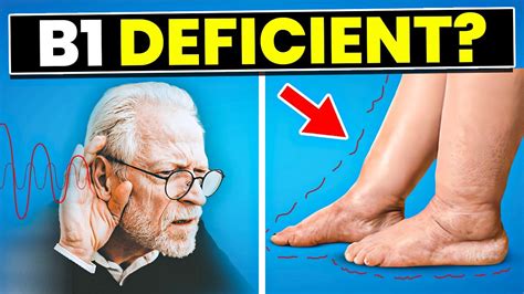 Vitamin B1 Thiamine Deficiency Signs Symptoms And Treatment Benefits