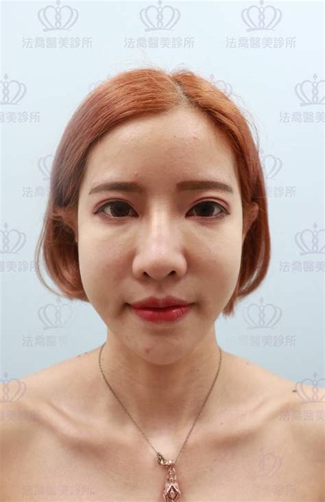 微整案例《dj Cyndi》洢蓮絲ellanse 微整注射 法喬醫美 法喬醫美診所台北台中高雄