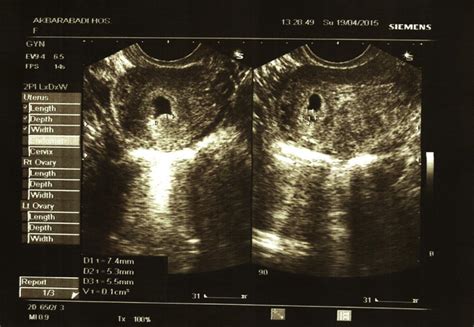 Transvaginal Image Of A Chorionic Bump Age Of Gestation 6 Weeks