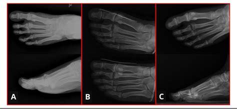 Figure 2 From Interpositional Arthroplasty With Extensor Digitorum