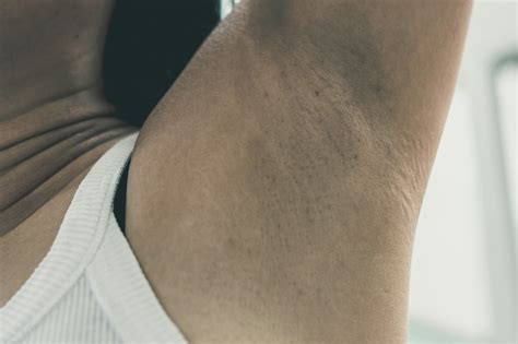 Botox Injections For Your Armpits Can Help Curb Sweating Heres What