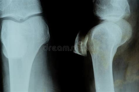X Ray Of A Patient With A Torn Meniscus Of The Knee Joint In A Man And