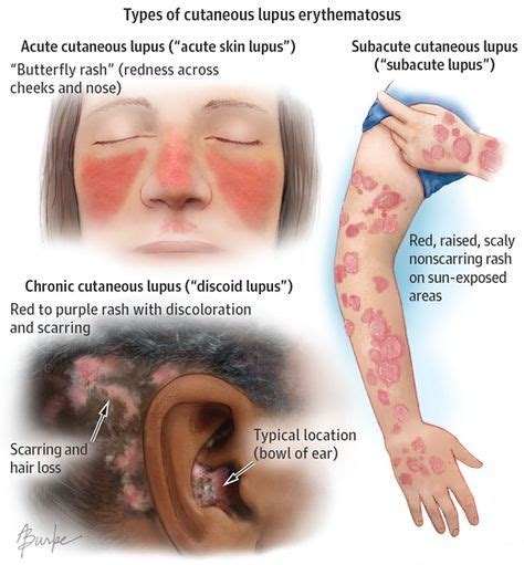 Cutaneous Lupus Erythematosus Jama Dermatol 20141503344 Doi101001jamadermatol2013