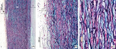 Aneurysms Of The Aorta Ascending Thoracic And Abdominal And Their