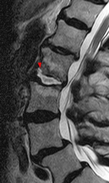 Discitis Radsource