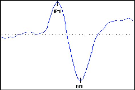 A Typical Vestibular Evoked Myogenic Potential Vemp Of A Normal Download Scientific Diagram