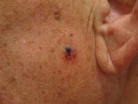 Dermoscopy Melanoma Skin Cancer Can Be Fatal Unless Caught Early But