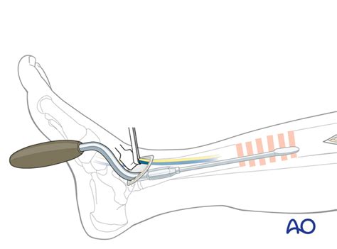 Mipo For Multifragmentary Tibial Fracture