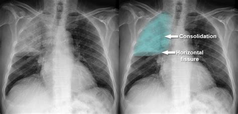 Radiology Chest Imaging Flashcards Quizlet
