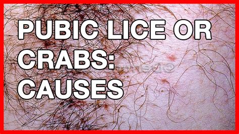 What Do Crabs Look Like Std At Beulah Insley Blog