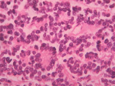 Ewings Sarcoma Primitive Or Peripheral Neuroectodermal Tumor