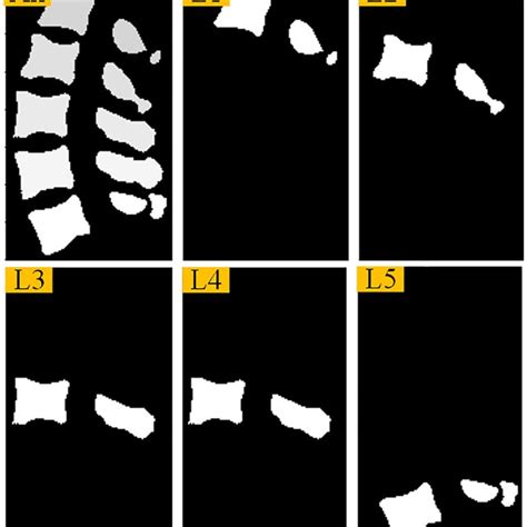 Effect Of Structural Similarity On Lumbar Image Segmentation Download