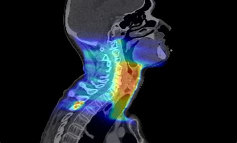 Eortc European Organisation For Research And Treatment Of Cancer On