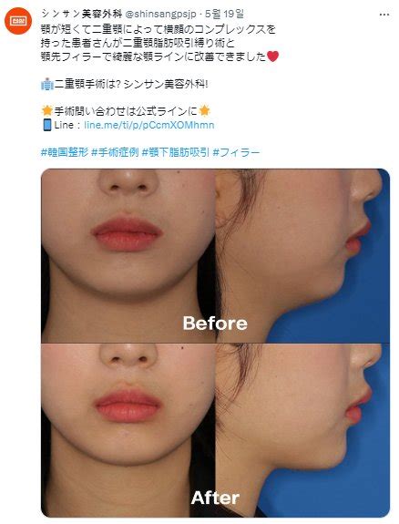 시술수술 질문 이중턱 수술을 조사 강남언니 1등 성형수술and피부시술 정보앱