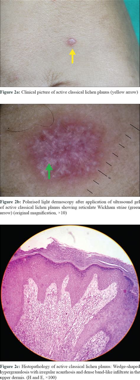 Dermoscopic Features Of Various Stages Of Lichen Planus Indian