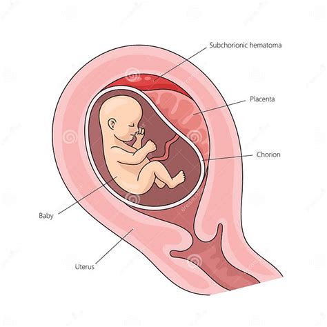 Placental Abruption Structure Medical Science Stock Illustration Illustration Of Science