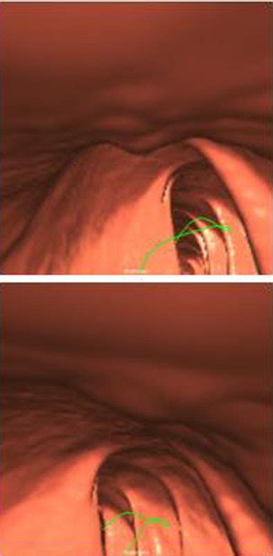 Hyperplastic Polyps Flatten Out With Vc Insufflation Auntminnie
