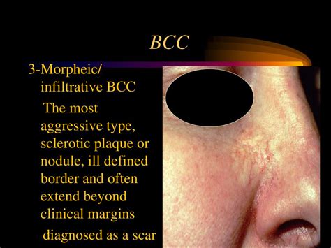 Ppt Medical Management Of Skin Cancer Powerpoint Presentation Free