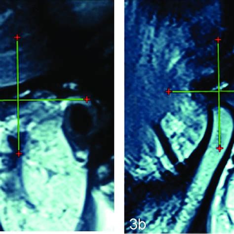 Opg Image Showing Bilateral Dislocation Of The Condyles Download