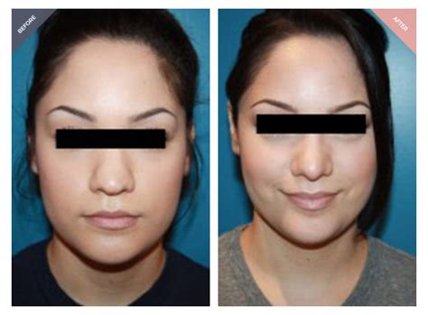 Nasal Tip Rotation Surgery What Is It And How Does It Help
