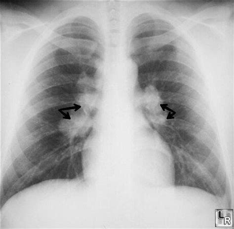 Eggshell Calcification