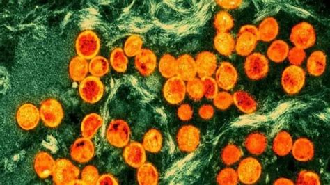 एमपक्स सङ्क्रमण समुदायमा फैलिन नदिन सरकार के गर्दै छ Bbc News नेपाली