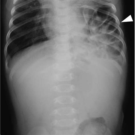 Preoperative Computed Tomography Computed Tomography Shows The