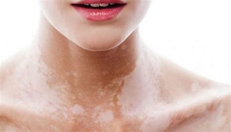 Want To Get Rid Of White Spots On Face Try These Effective Remedies