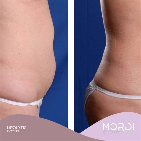 Lipolytic Enzymes Mordi Beauty Clinic