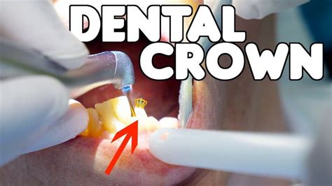 Dental Crown Procedure Explained Youtube Dental Crown Procedure