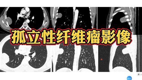 胸膜孤立性纤维瘤CT图像分享初学者收藏学习 影像科刘医生 影像科刘医生 哔哩哔哩视频