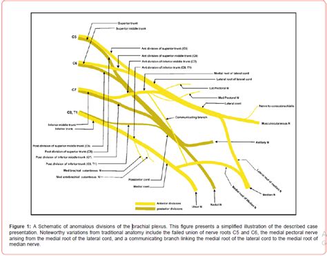 Independent C5 And C6 Superior Trunks Of The Brachial Plexus With An