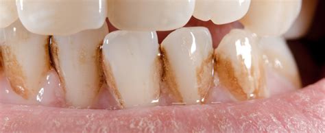 Ortodontia é Arte Alimentos Que Causam Manchas Nos Dentes