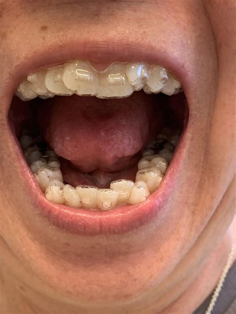 Did Anyone Not Need Refinements R Invisalign