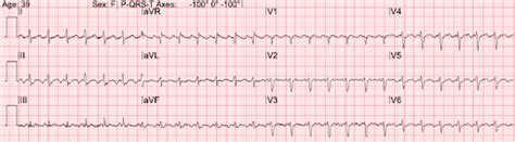 Bifascicular Blocks Brash Syndrome And So Much More Ecg Weekly