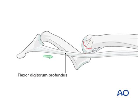 Dislocation Of The Proximal Interphalangeal Joint