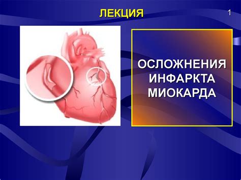 Осложнения инфаркта миокарда презентация онлайн