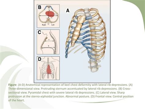 Congenital Chest Wall Abnormality Pptx