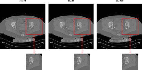 Figure 1 From A Deep Learning Based Method For Automatic Segmentation Of Proximal Femur From