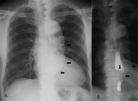Mildly Tortuous Thoracic Aorta Causes Symptoms And Tr