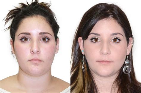 Asymmetrical Face Correction