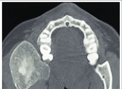 Ossifying Fibroma Of The Mandible Download Scientific Diagram