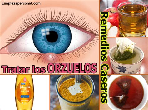 15 Remedios Naturales Para Curar Orzuelos Limpieza E Higiene Personal
